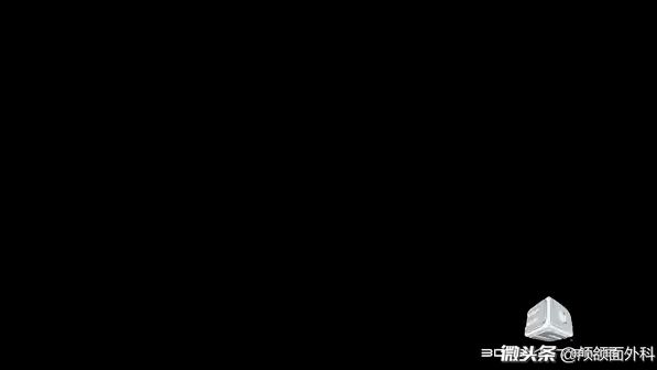 计算机辅助虚拟手术设计,三维导板应用辅助牵引成骨,颧骨修复