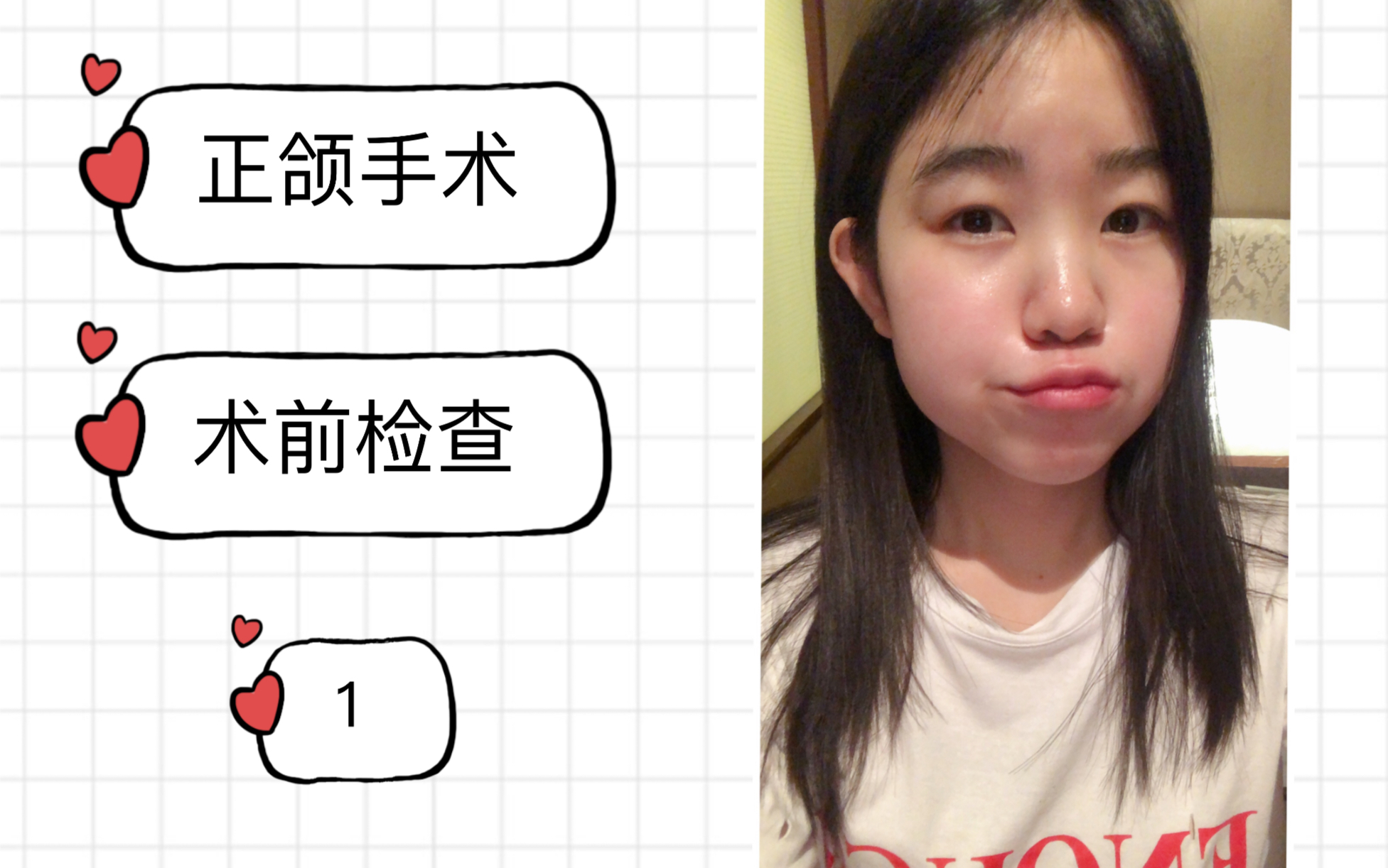 反颌+偏颌的正畸正颌联合治疗-术前检查(1)
