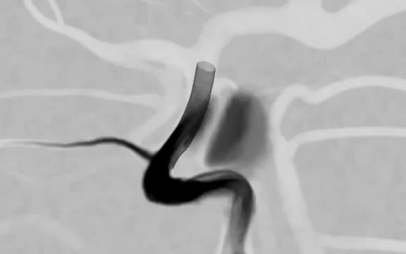 因为输送系统被召回的密网支架