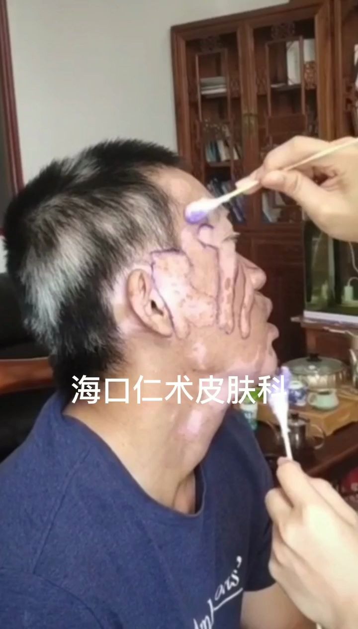 海口脸部白癜风治疗