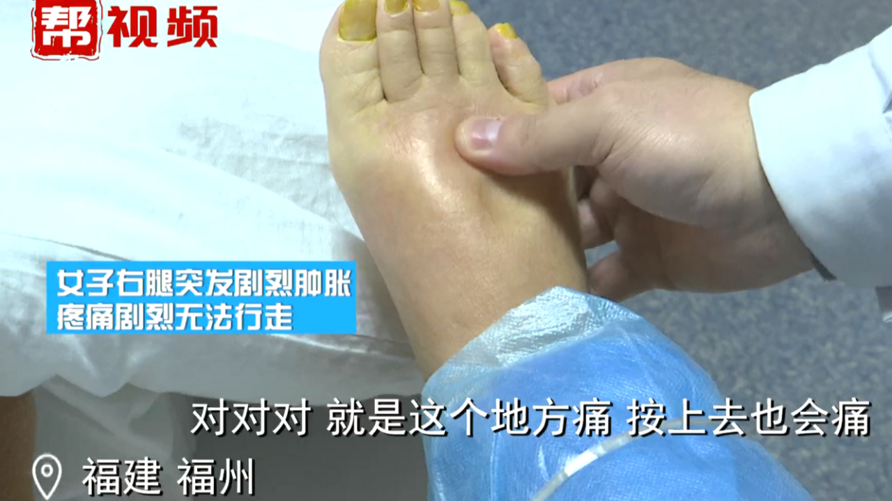 长时间躺床上看手机不运动,女子右腿突发肿胀疼痛,或致命