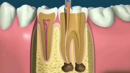 3D动画演示根管治疗过程