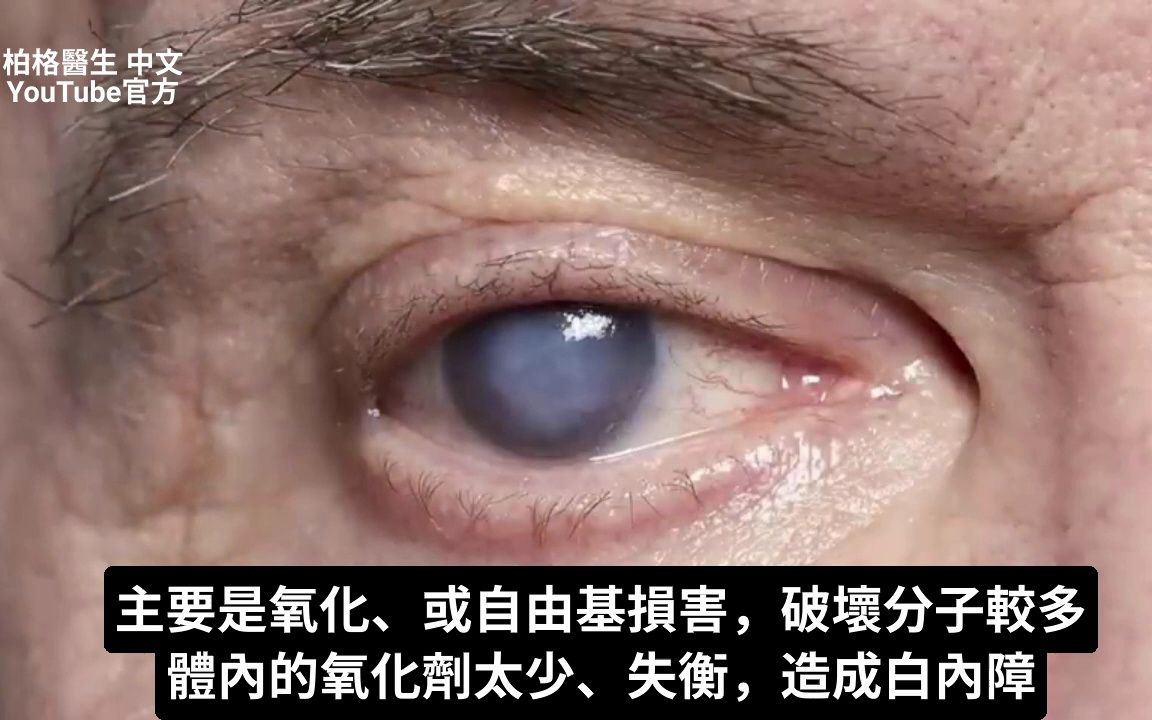 預防白內障的11個原因, 最佳自然療法,柏格醫生 Dr Berg