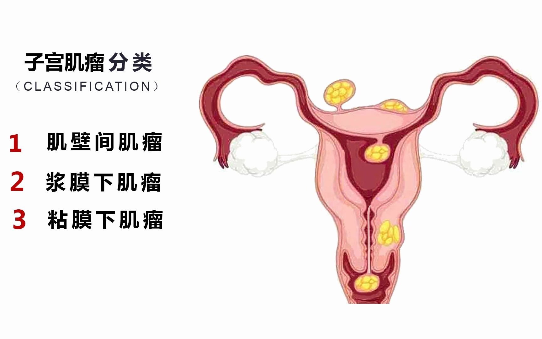 PPT医学课件-子宫肌壁的结构及子宫肌瘤分类动画