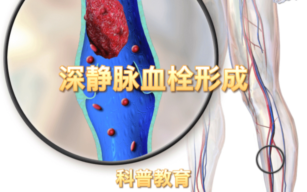 深静脉血栓形成科普教育