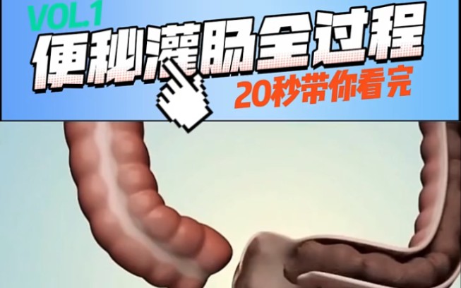 便秘灌肠的操作过程,20秒带你来了解