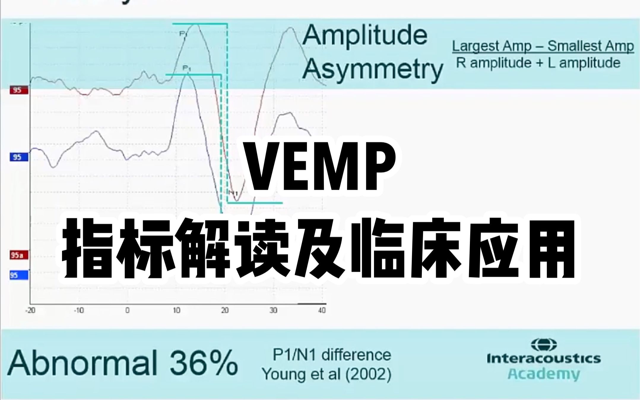 VEMP ②如何解读VEMP的幅度、阈值和刺激声频率,VEMP临床应用| ...