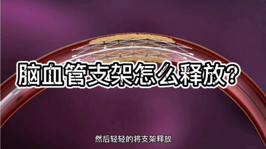 脑血管的支架是怎么释放的?