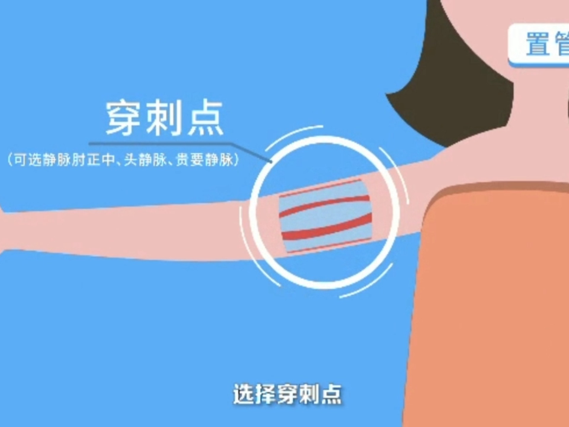 迷你中长静脉导管置管、维护及注意事项