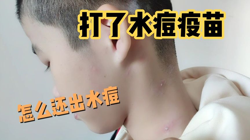 13岁儿子打过水痘疫苗怎么还出水痘,难道是疫苗不管用吗
