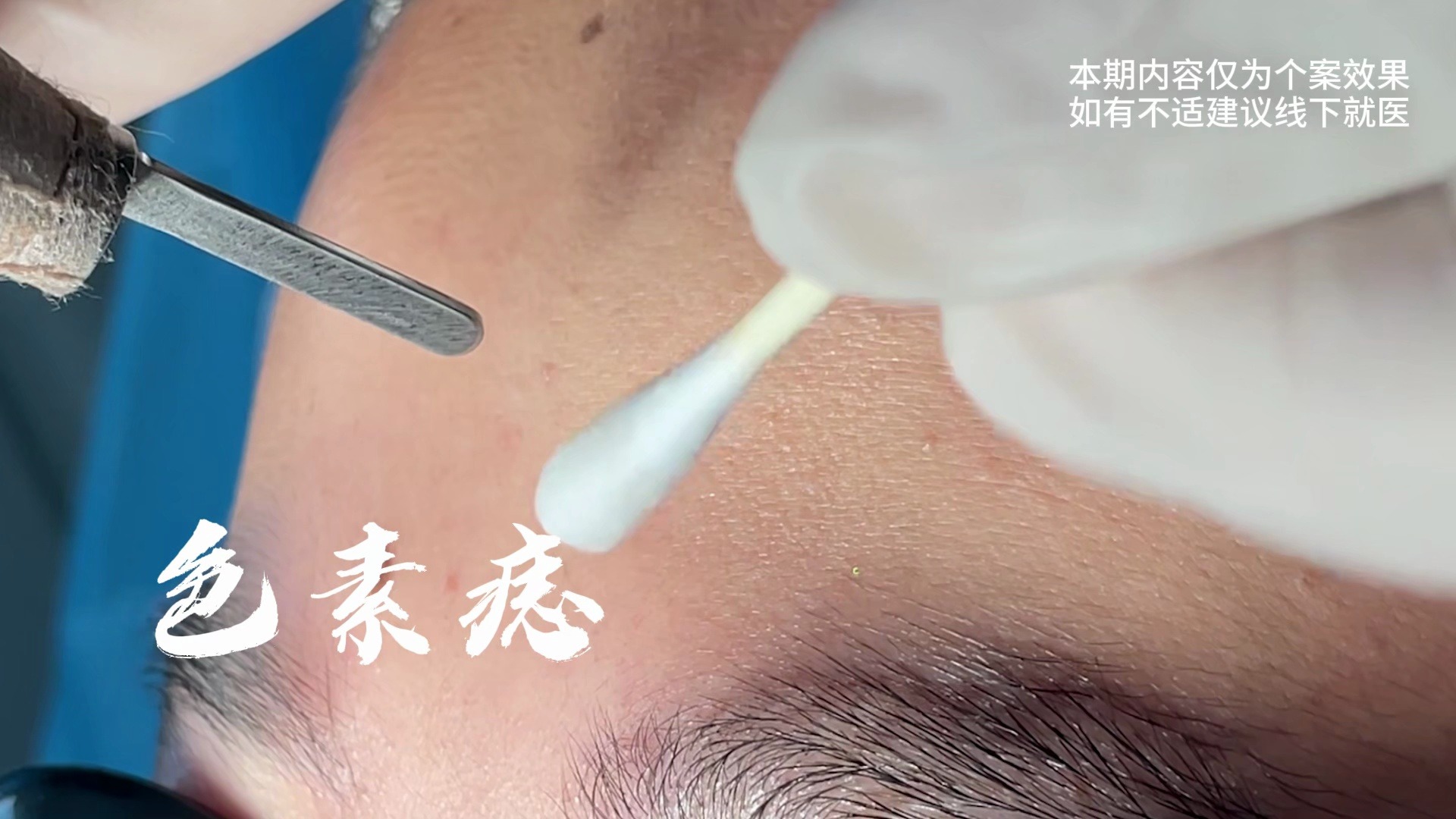 激光治疗色素痣实拍