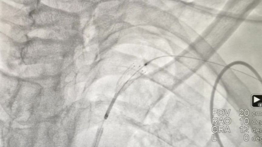 自膨式支架是怎样释放的?#锁骨下动脉狭窄 #神经介入 #手术