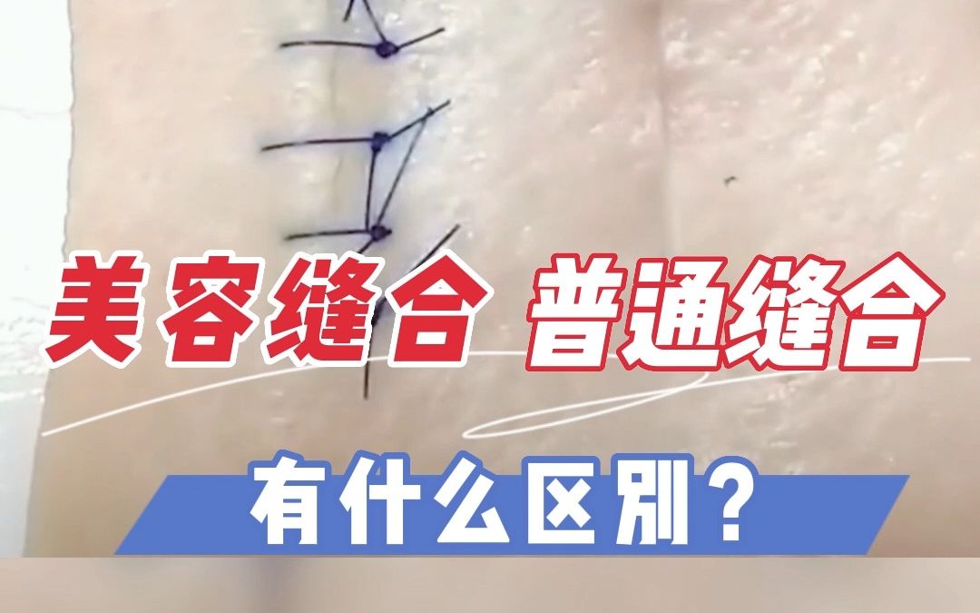 美容缝合和普通缝合有什么区别?网友:整形医生都是好裁缝!