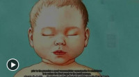 视网膜母细胞瘤RB经眼动脉灌注化疗动画_腾讯视频_2