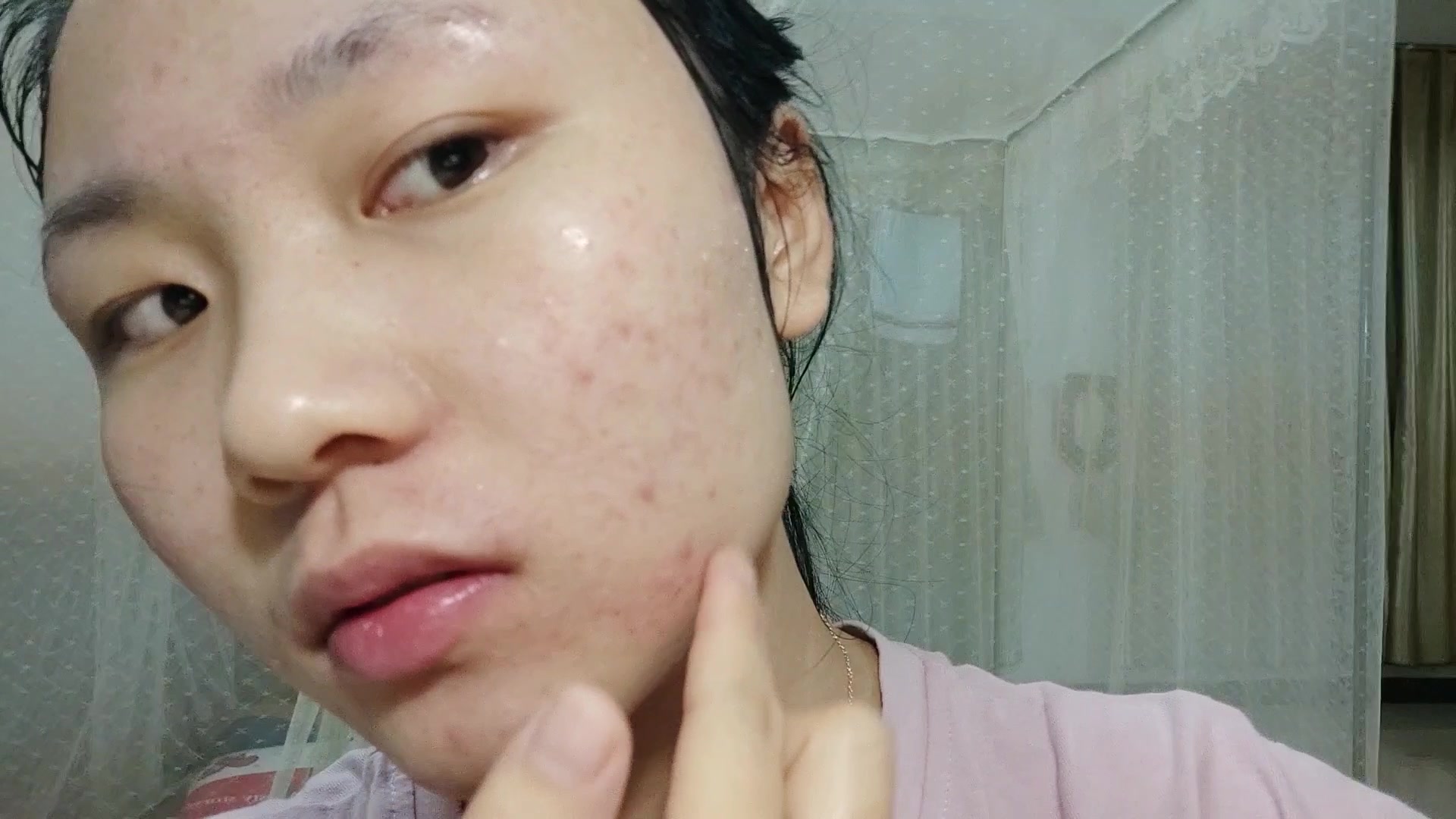 密集恐惧症慎点!无滤镜无美颜,换季烂脸分享原因,希望引起各位姐妹...