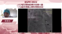 靳雅琼:无导线起搏器植入病例分享