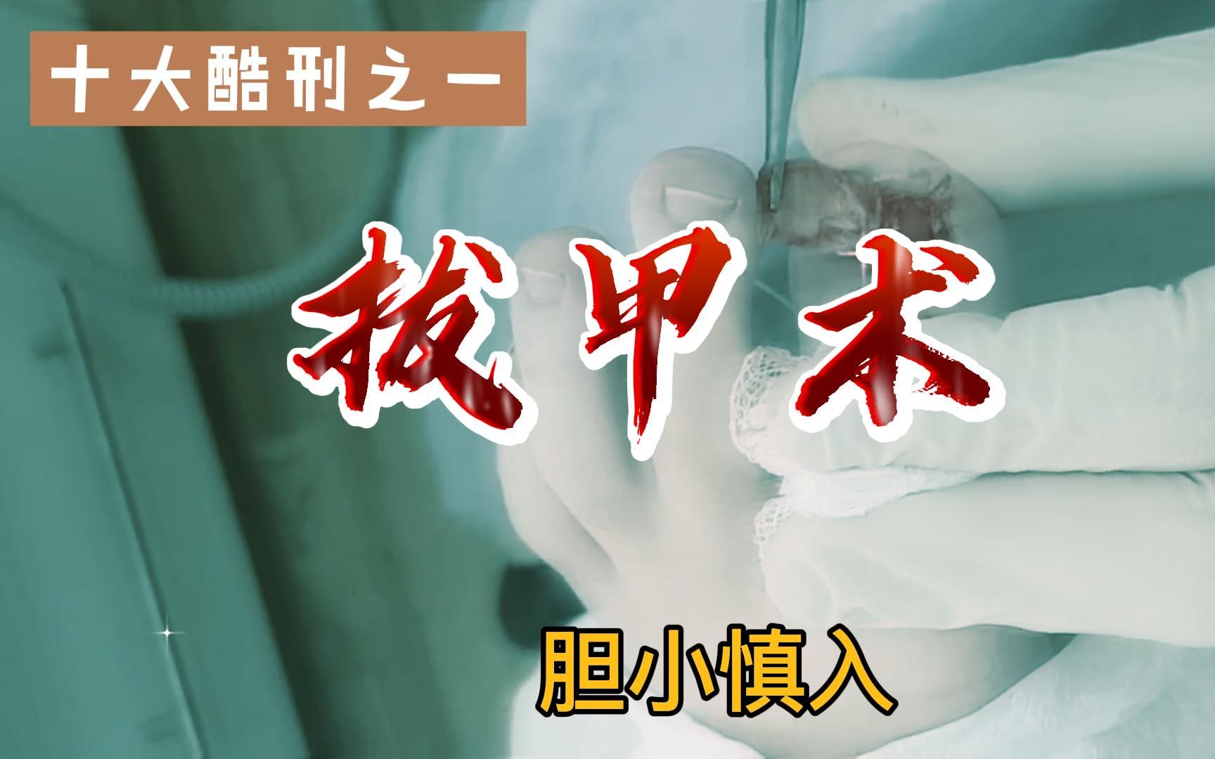 古之酷刑:拔甲术| 胆小慎入