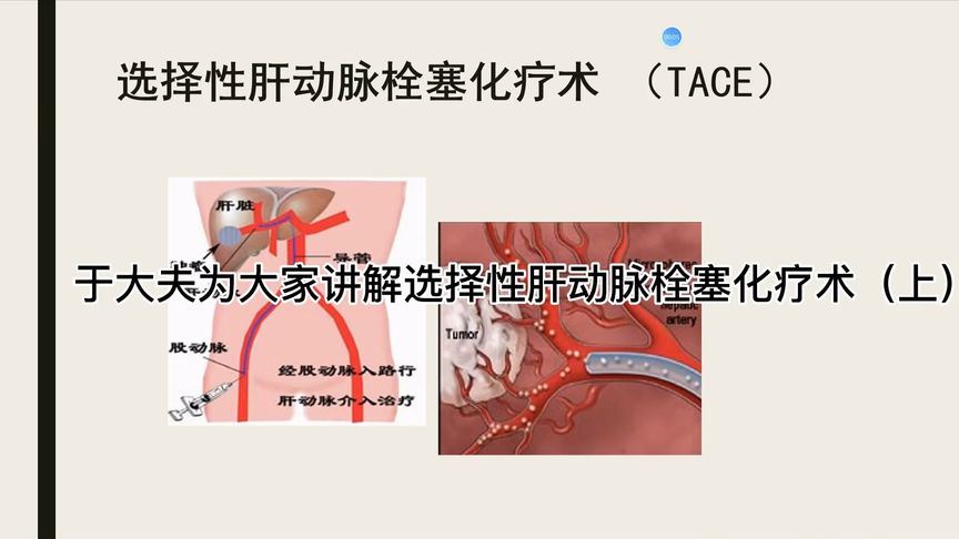 今天于大夫给大家讲解的是选择性肝动脉栓塞化疗术