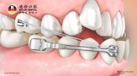 动画牙齿矫正视频全过程-地包天先打开咬合再内收, 操作效果示例