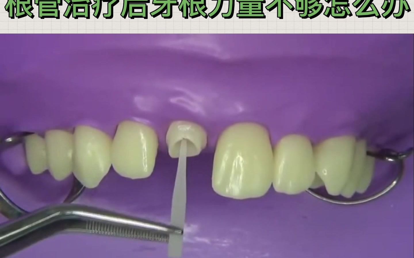 根管治疗后牙根力量不够怎么办?还能保留吗?