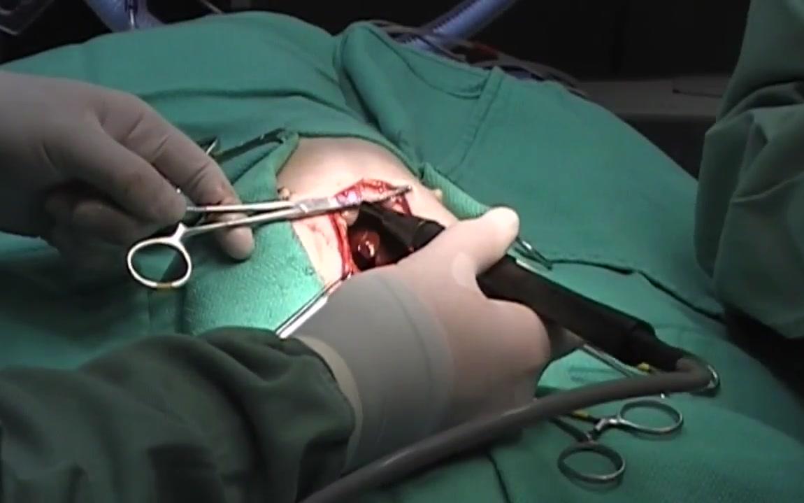 动物医院——胆总管取石术