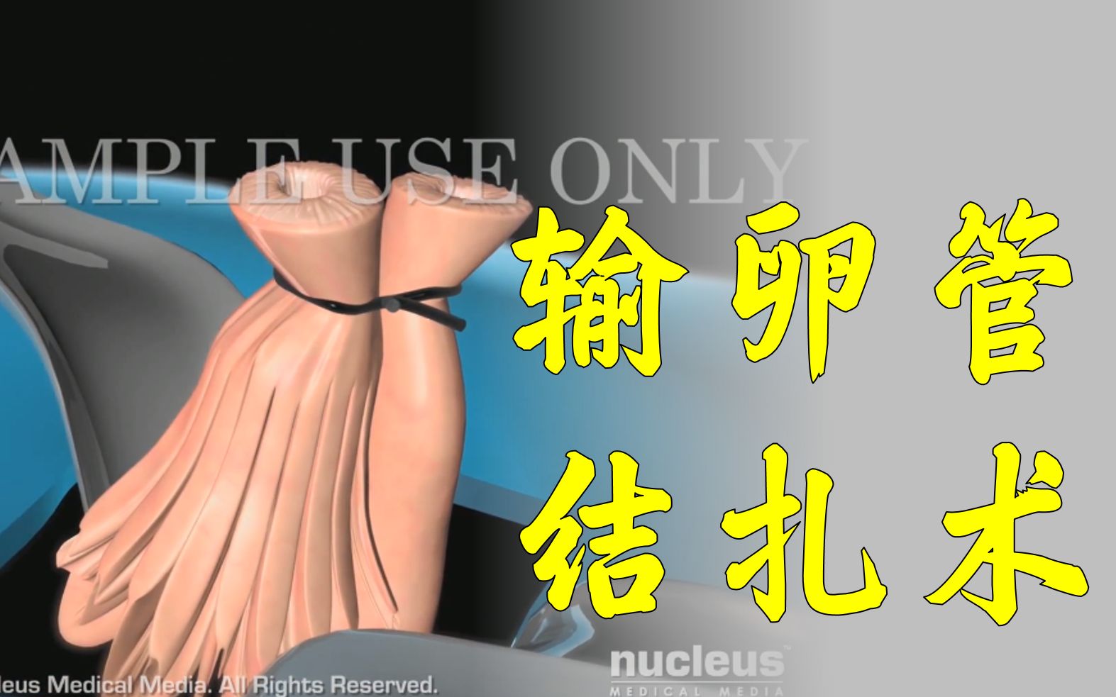 【3D医学动画】女生慎入_输卵管结扎(中英双字幕)