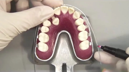 模型演示牙齿正畸操作过程,太治愈了