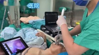 清醒气管插管(赛新可视管芯)