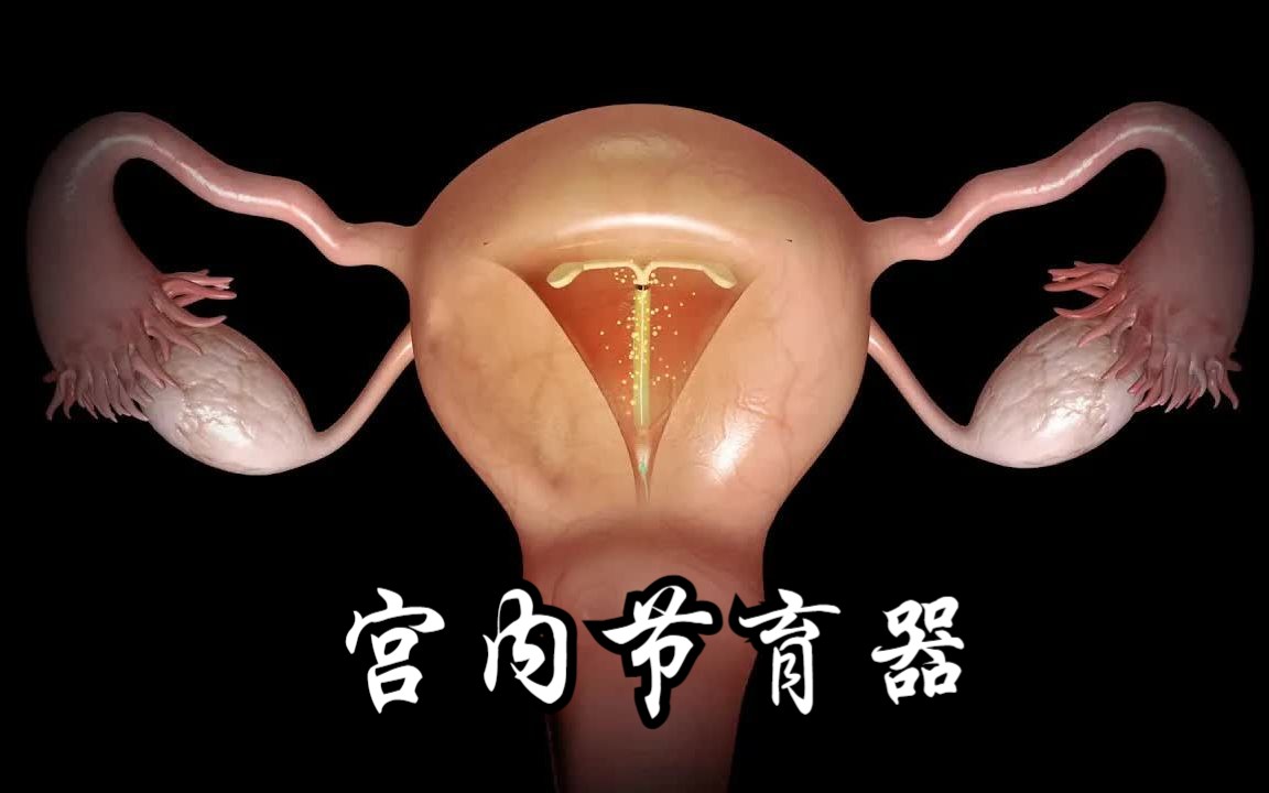 3D演示:宫内节育器的工作原理