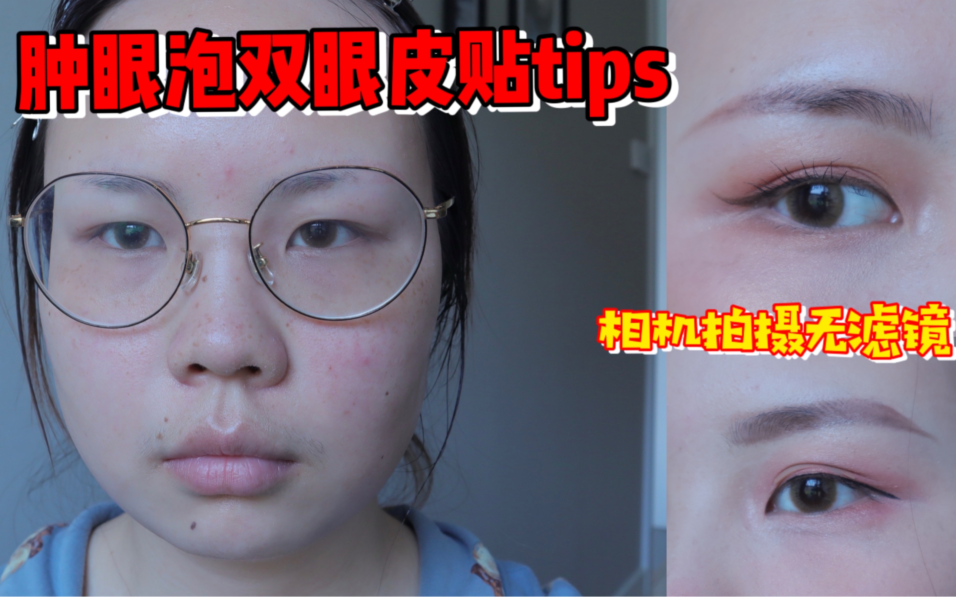 圆脸肿眼泡|ߑ�双眼皮贴怎么选择和使用ߤ