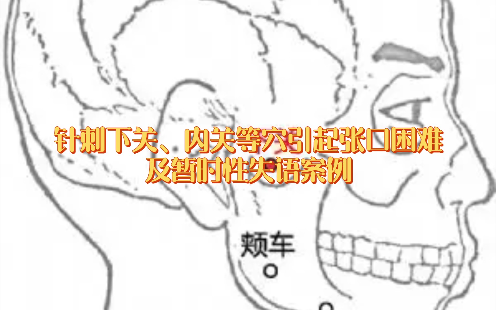 针灸意外及防治(四十八)针刺下关、内关等穴引起张口困难及暂时性...