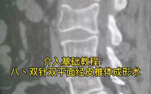 介入基础教程 八 双针双平面骨水泥成形术