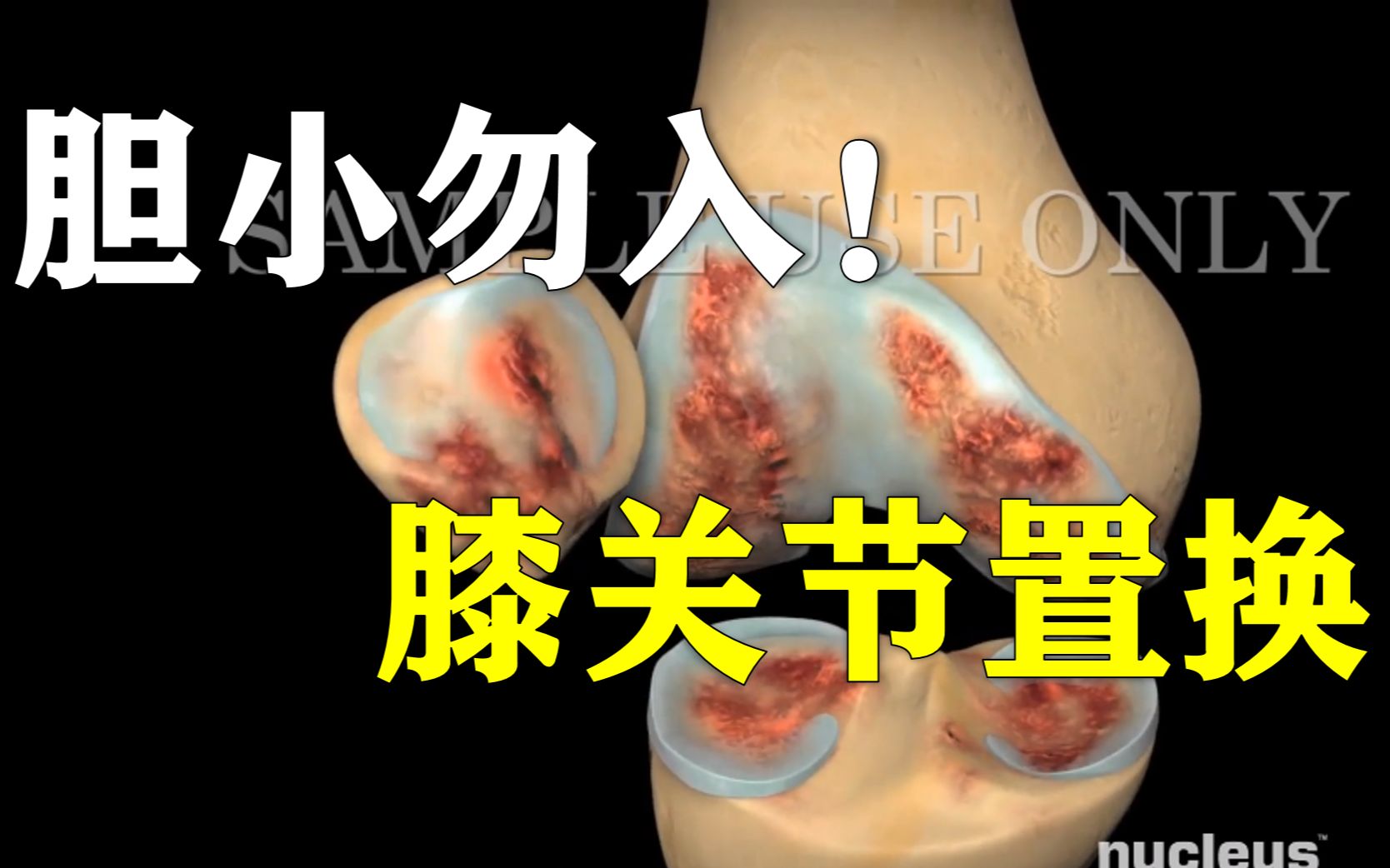【3D医学动画】胆小勿入!_膝关节置换(中英双字幕)
