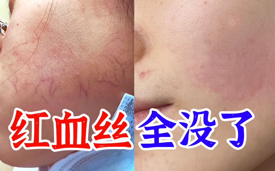 【小博门诊】红血丝一秒消失 | 激光祛红血丝实录