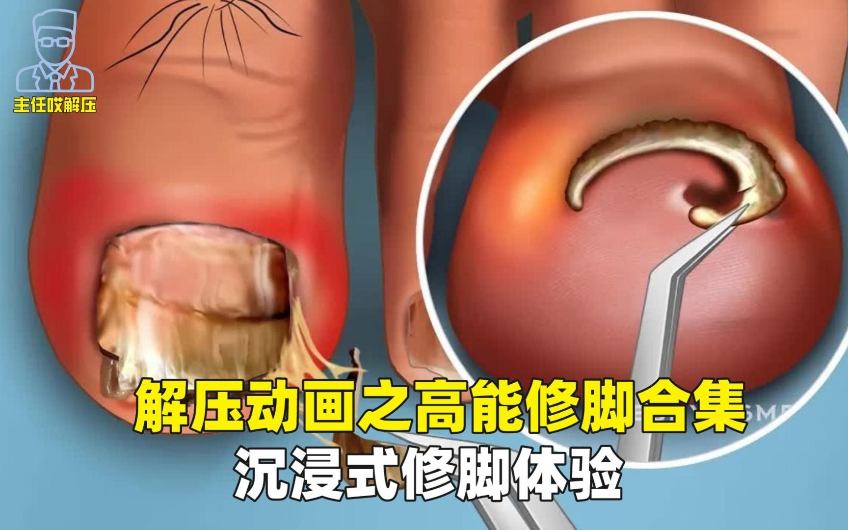 解压动画,高能修脚合集,沉浸式修脚体验