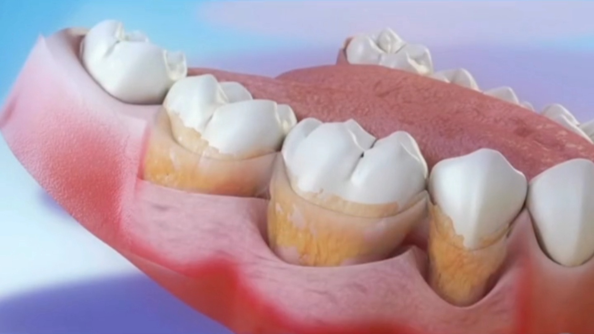 牙周炎治疗方法——龈下刮治