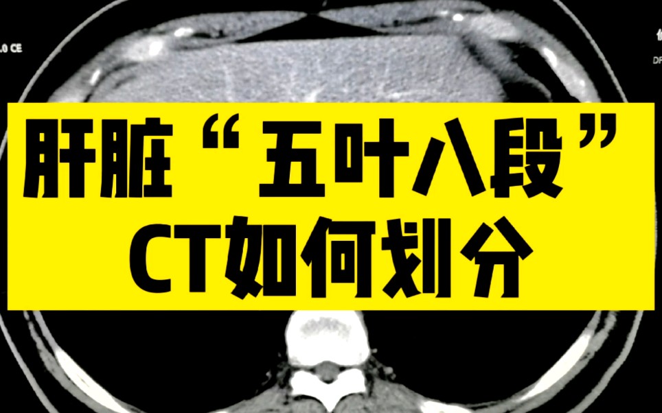 肝脏“五叶八分段”如何在CT上划分,放射科医生详细讲解!
