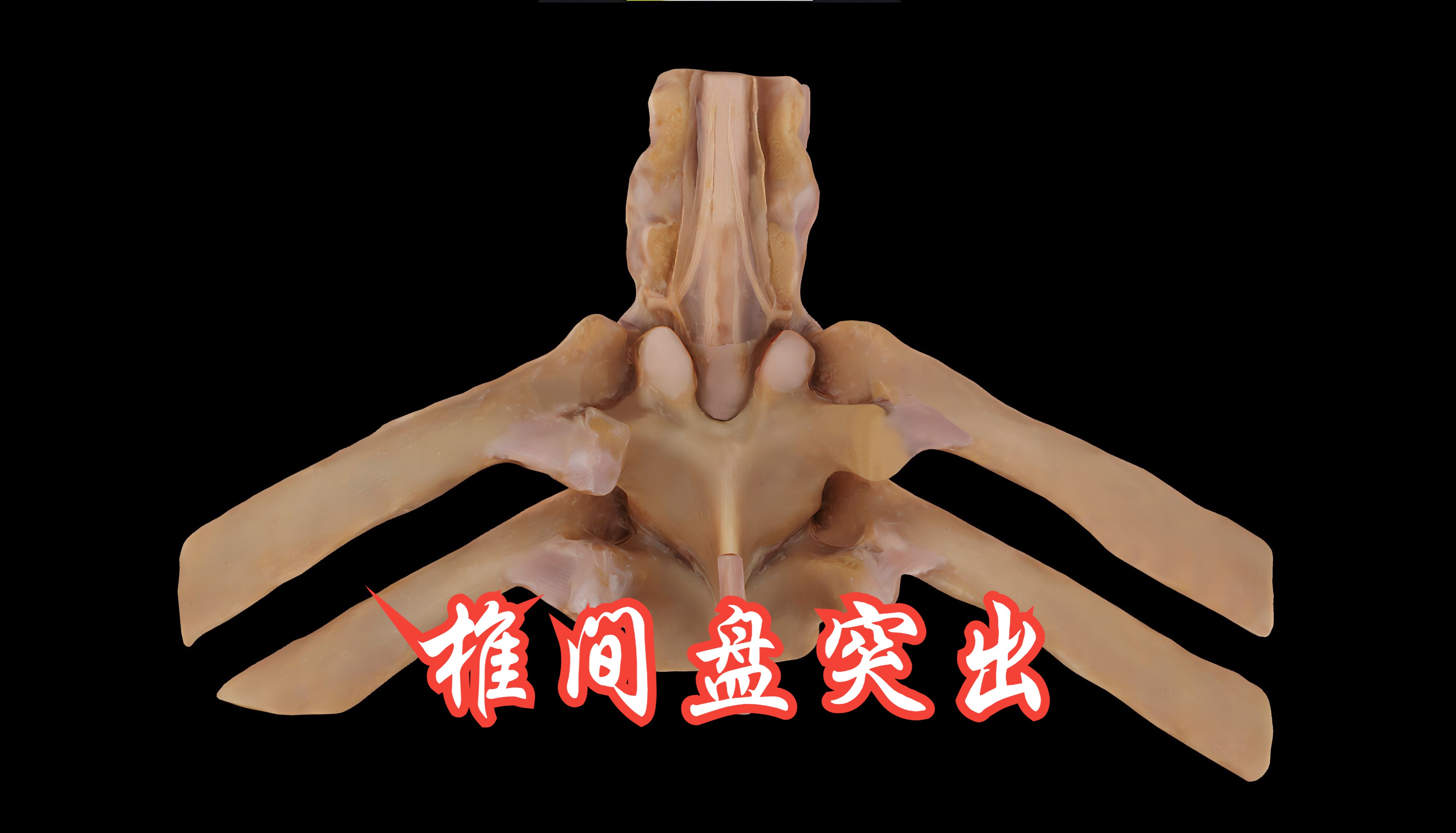 椎间盘突出,受伤的为什么都是脊神经