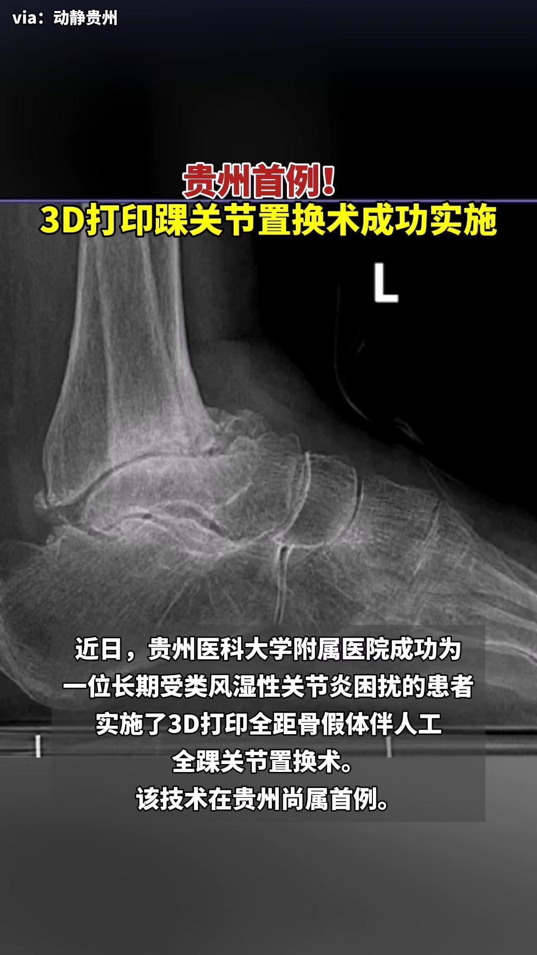 贵州首例!3D打印踝关节置换术成功实施#3D打印踝关节#医学科普#踝...