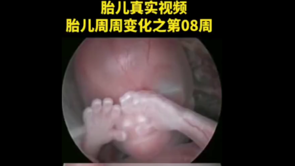 第62集:在胚胎镜下八周胎儿的真实视频,胎宝宝蒙着双眼和你躲猫猫呢!...