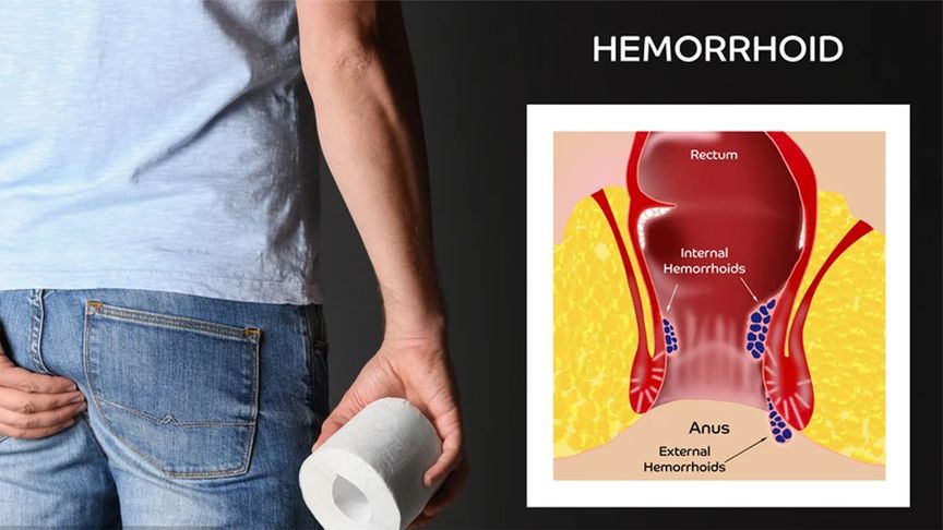 看完痔疮手术的真实感受:痛就一个字,真的可以喊到结束!