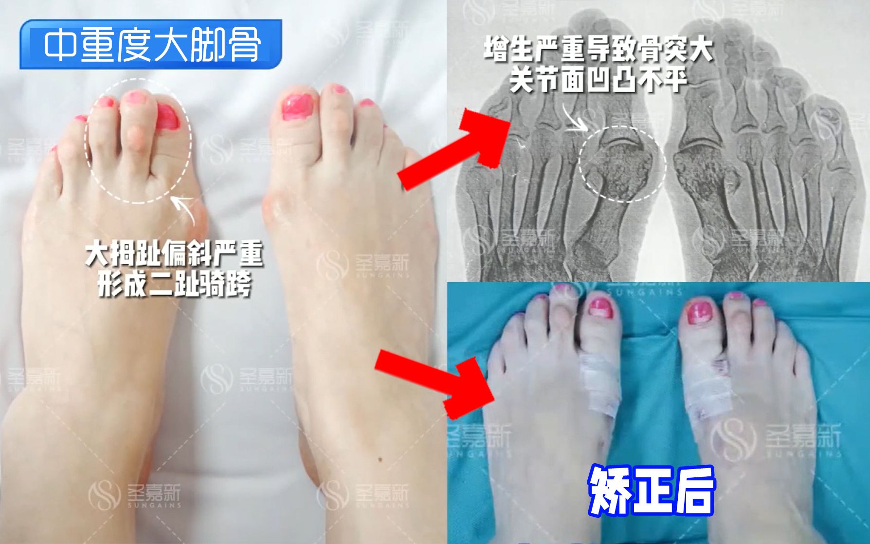 北京苏敬达医生:跳过舞的阿姨,手术矫正多年的拇外翻,术后美观多了