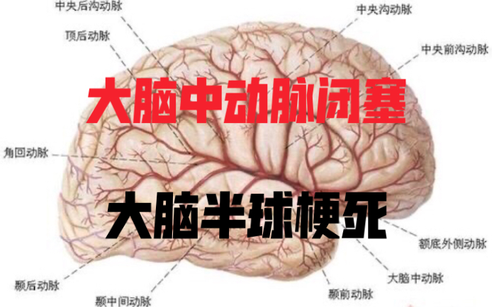 [脑血管疾病6】大脑中动脉闭塞型脑梗死