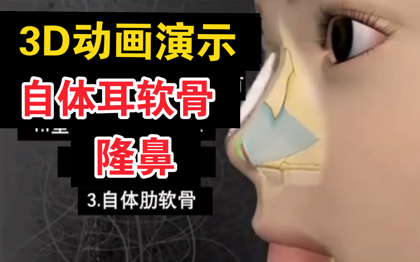 【自体耳软骨隆鼻】3D动画演示自体耳软骨隆鼻全过程!