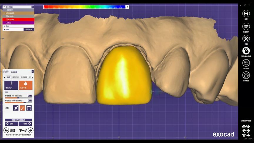 前牙美学贴面设计方法,牙宝带你学习如何用EXOCAD软件设计贴面