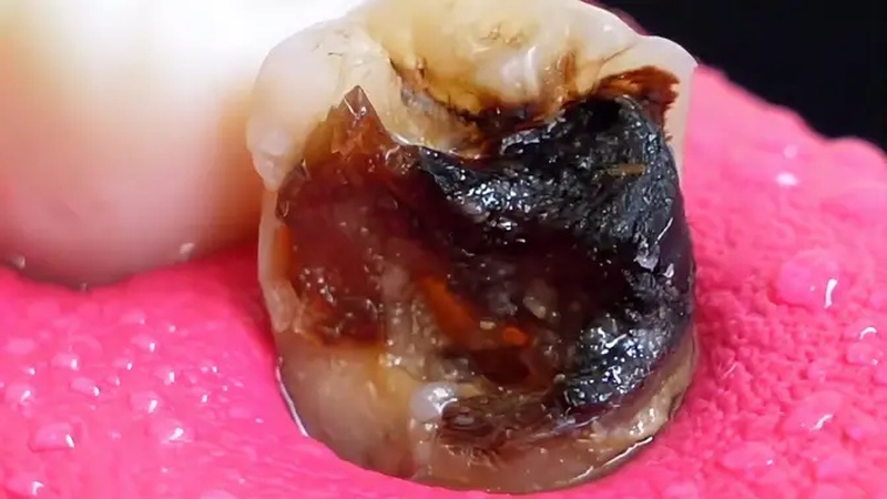 根管治疗治疗有多爽,看完实在太解压了