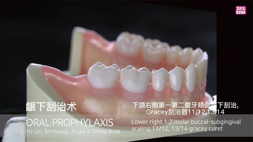 龈下刮治.mp4