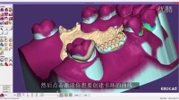 exocad活动支架教程