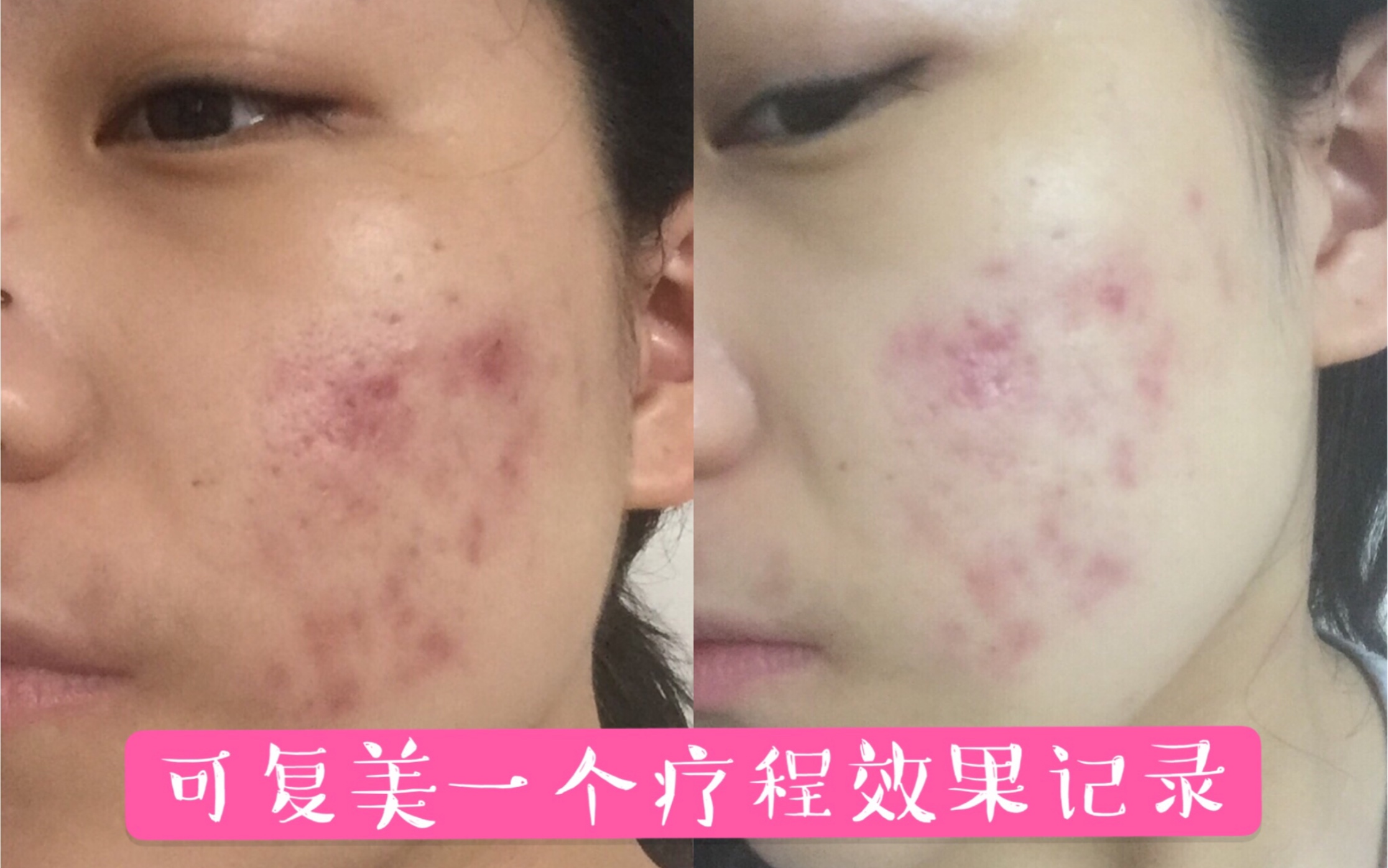 可复美一个疗程使用效果记录!