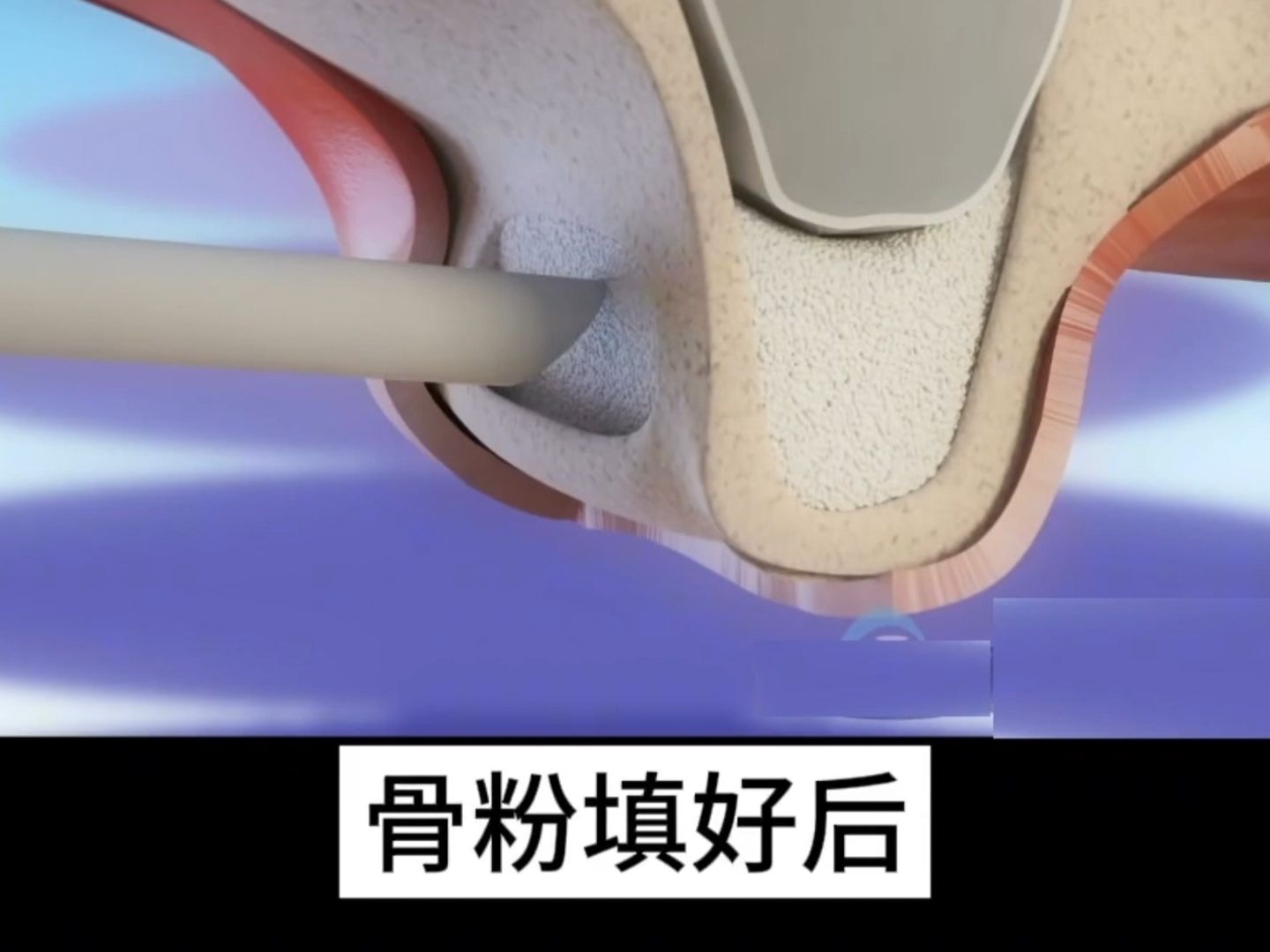 上颌窦外提手术是什么?全面解析植骨流程!